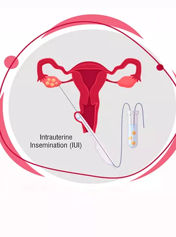 IUI Process: Understanding IUI Procedure Step by Step | Indira IVF
